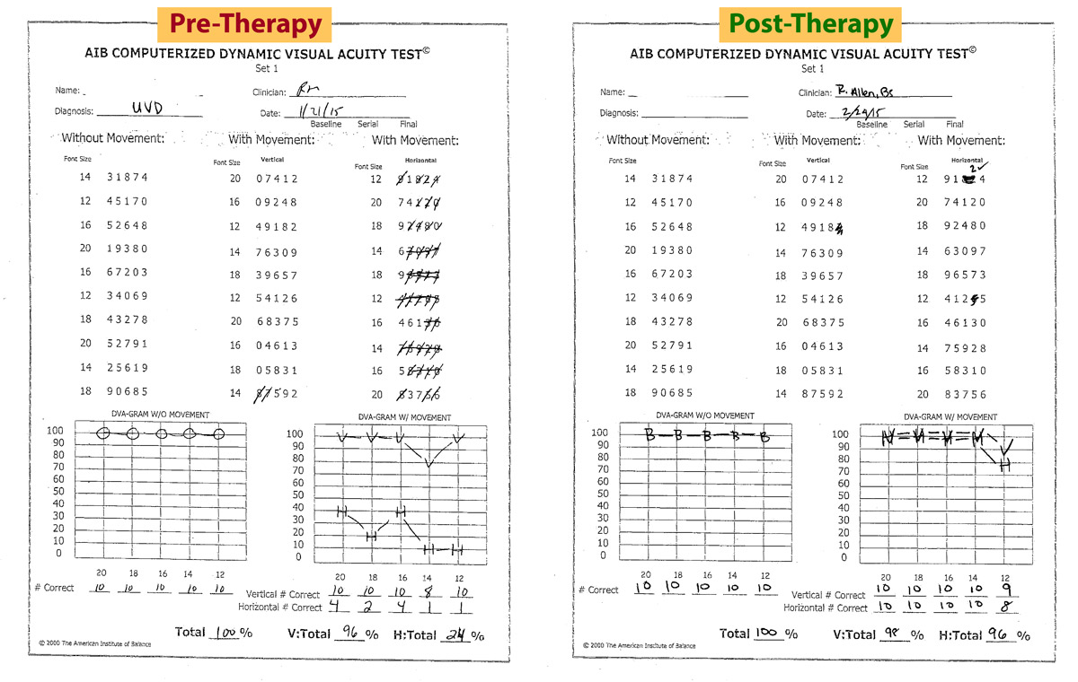 CASE STUDY: Home-based Vestibular Rehabilitation (VRT) Program: Measuring Outcomes with vHIT and ...