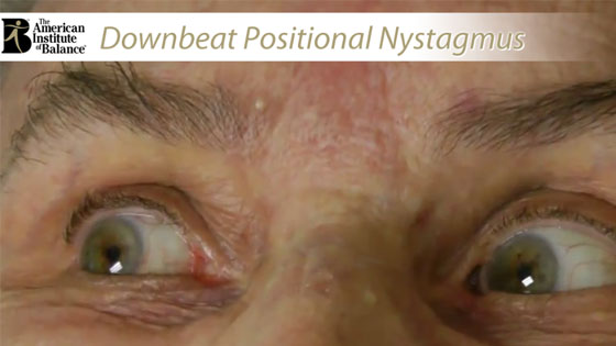 Video Cardiogenic Vs Cns Downbeat Nystagmus Dbn The American
